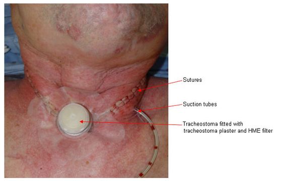 Stimmprothese » Laryngectomy